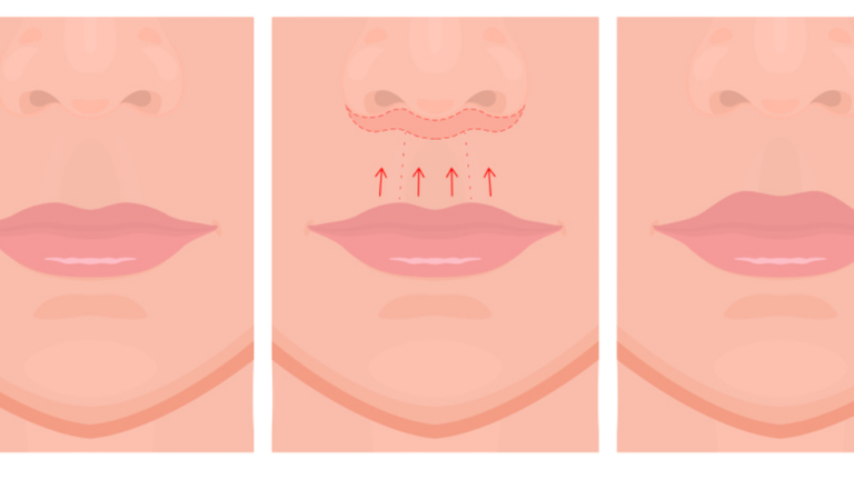 Lip Lift in Istanbul - Dr. Murat Benzer